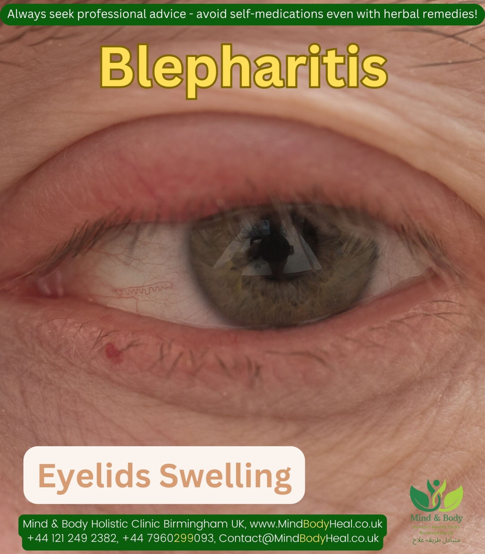 Eyelids swelling – Blepharitis – Suggested complimentary remedies ...