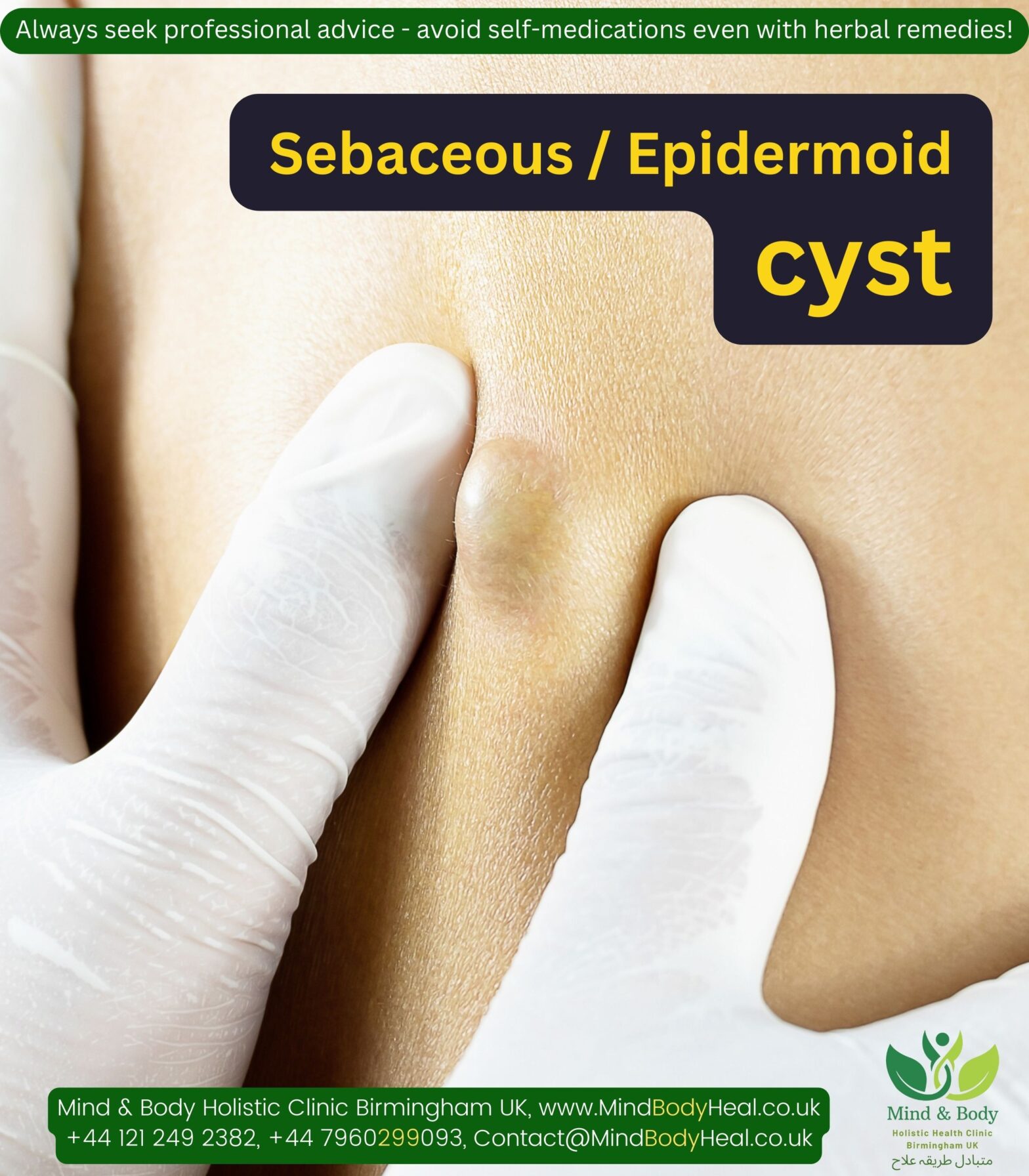 Sebaceous / epidermal cysts – Suggested complimentary remedies – Mind ...