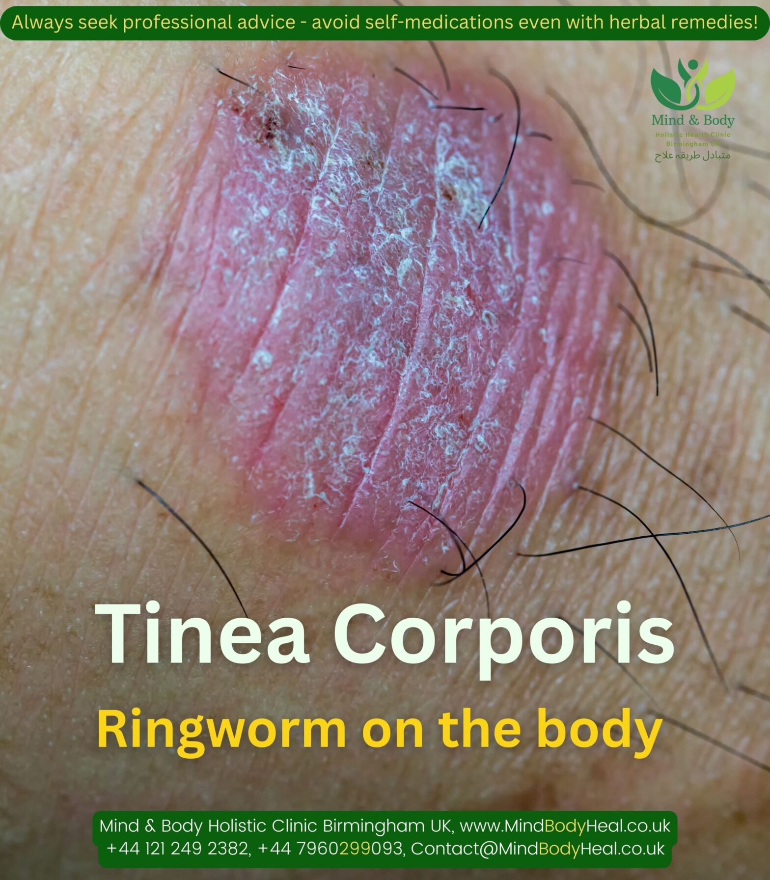 Tinea Corporis - fungal infection - Suggested complimentary remedies ...